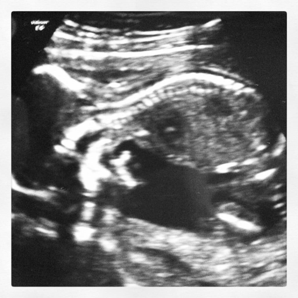 21 Weeks Pregnant Ultrasound
